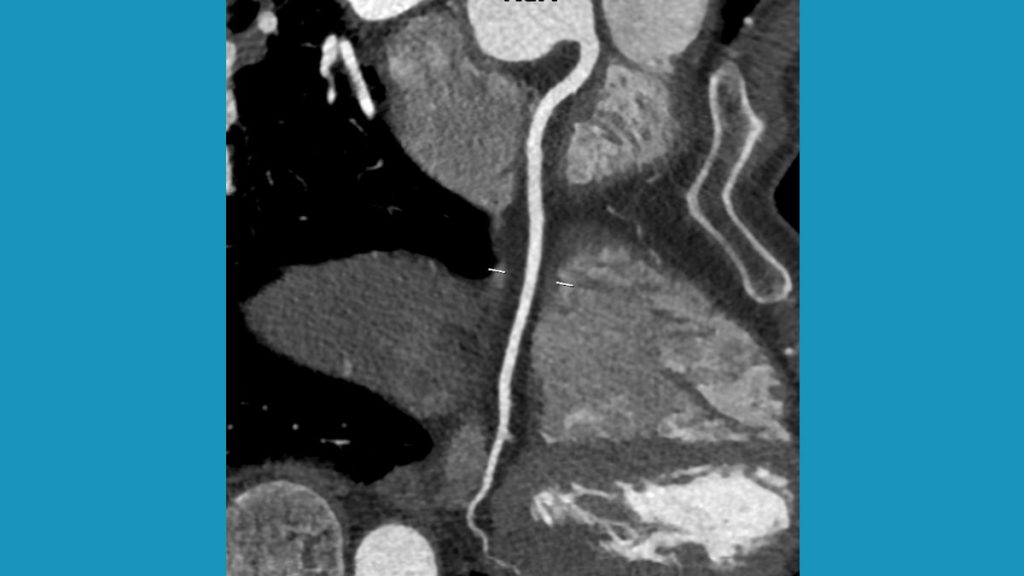 Clínica Puerto Varas » AngioTAC de Arterias Coronarias: Alta Resolución ...